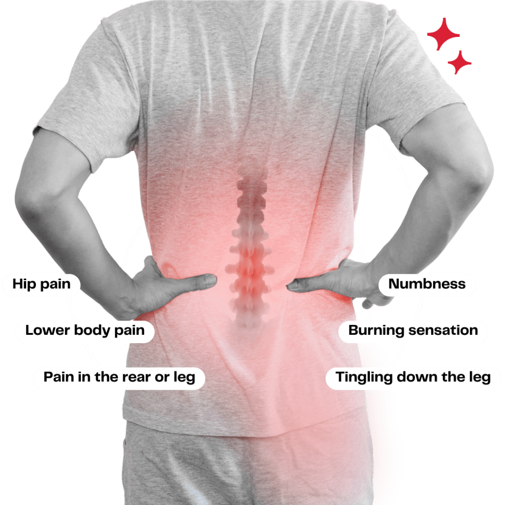 Sciatica - Lo Physio